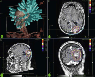 Stereotactic Radiosurgery (SRS) | AARO SG