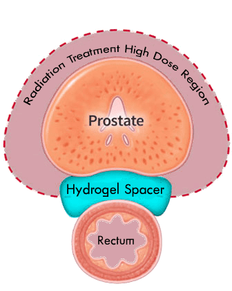 SpaceOar Hydrogel - Prostate Cancer Treatment - AARO SG